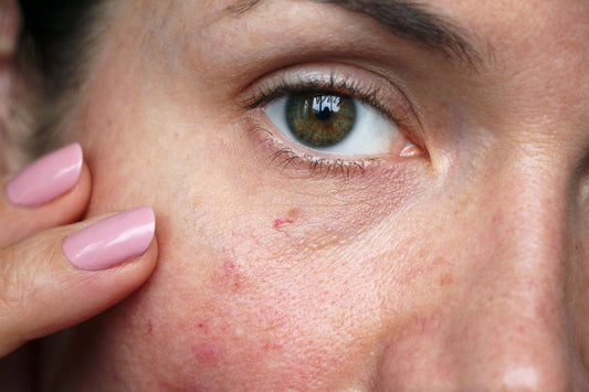 Acrochordons, point de rubis, petits vaisseaux (Thermocoagulation)